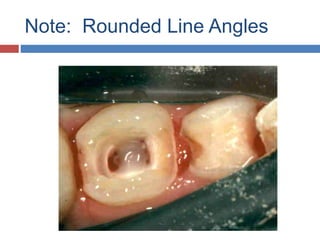 Stainless steel crowns for primary teeth | PPT