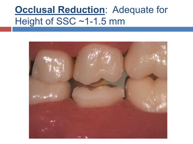 Stainless steel crowns for primary teeth | PPT