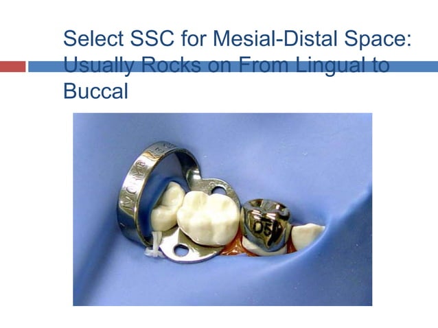 Stainless steel crowns for primary teeth | PPT