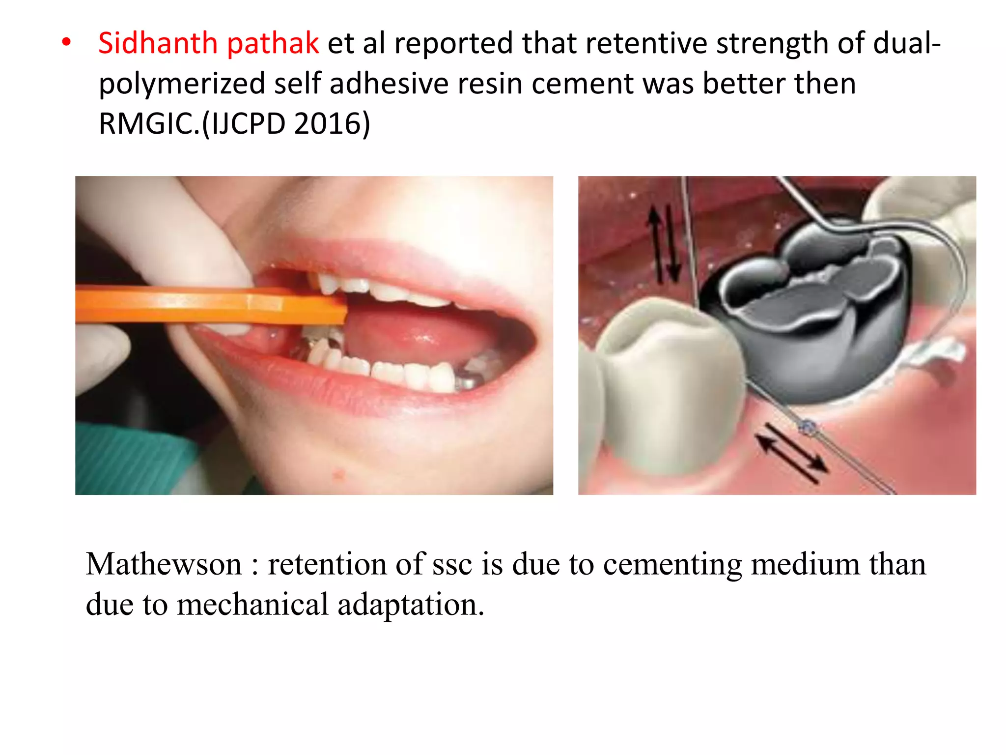 Stainless steel crowns in pediatric dentistry ppt | PPTX