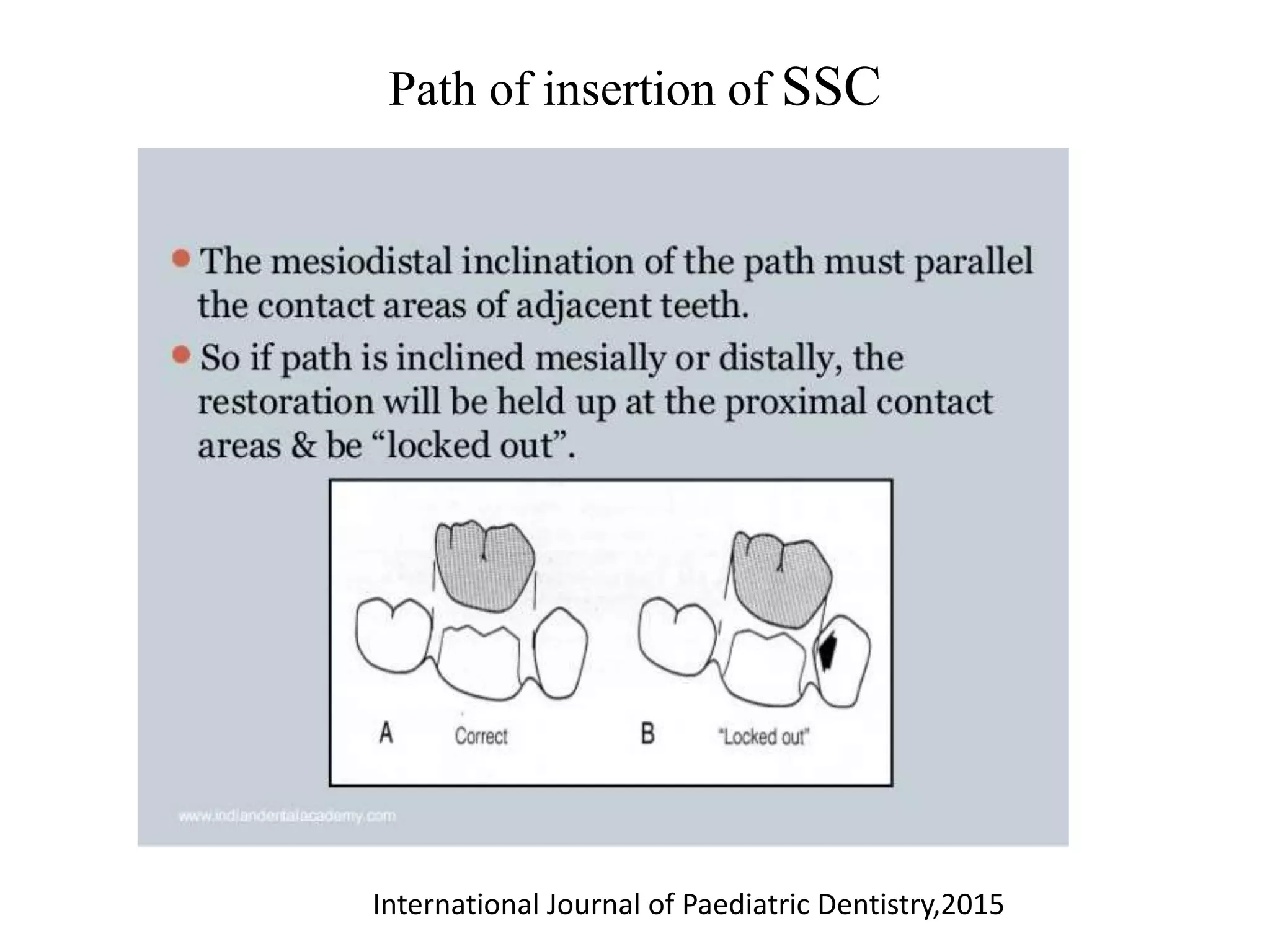 Stainless steel crowns in pediatric dentistry ppt | PPTX