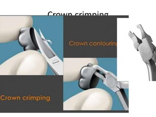 Stainless steel crowns in pediatric dentistry ppt | PPTX
