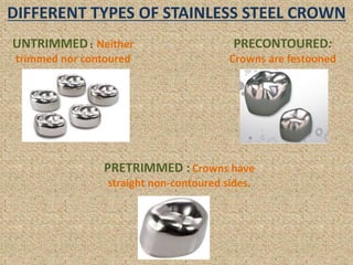 Stainless steel crowns (PEDODONTICS) | PPTX