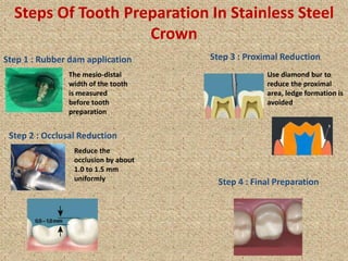 Stainless steel crowns (PEDODONTICS) | PPTX