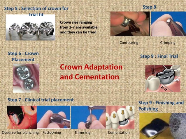 Stainless steel crowns (PEDODONTICS) | PPTX | Dental Health | Diseases ...