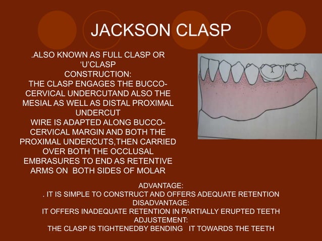 Stainless Steel + Removable Appliances | PPT