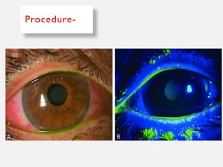 Dyes/ Stain Used In Ophthalmology - Clinical uses, Indication & Side ...