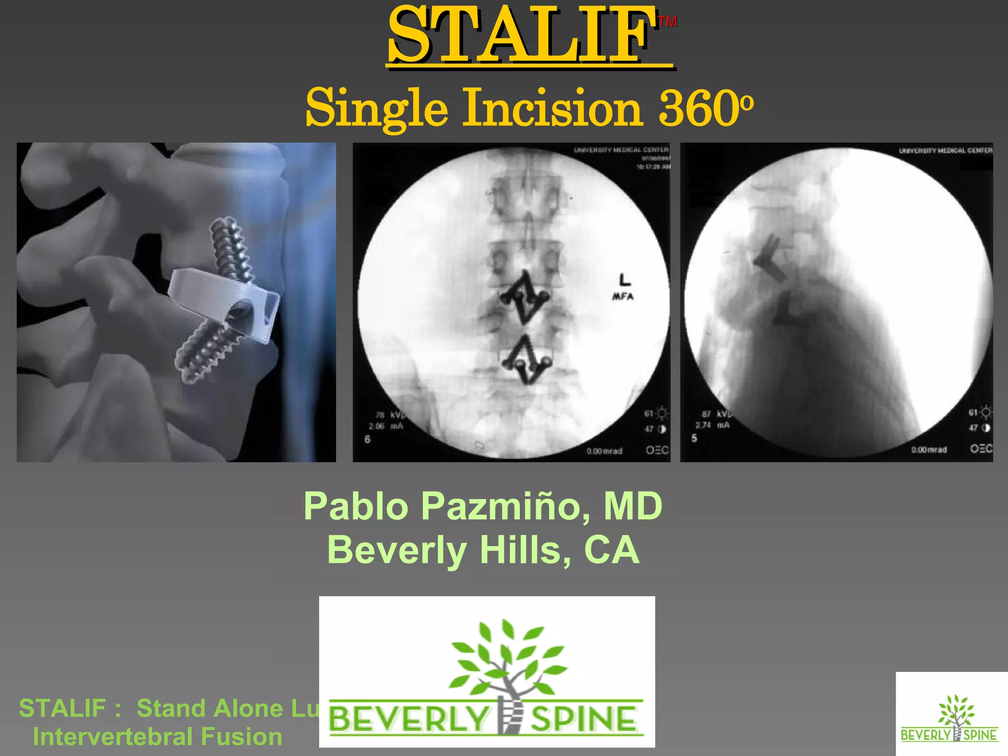 Lumbar Fusion : A New Anterior Only Option. The STALIF | PPT