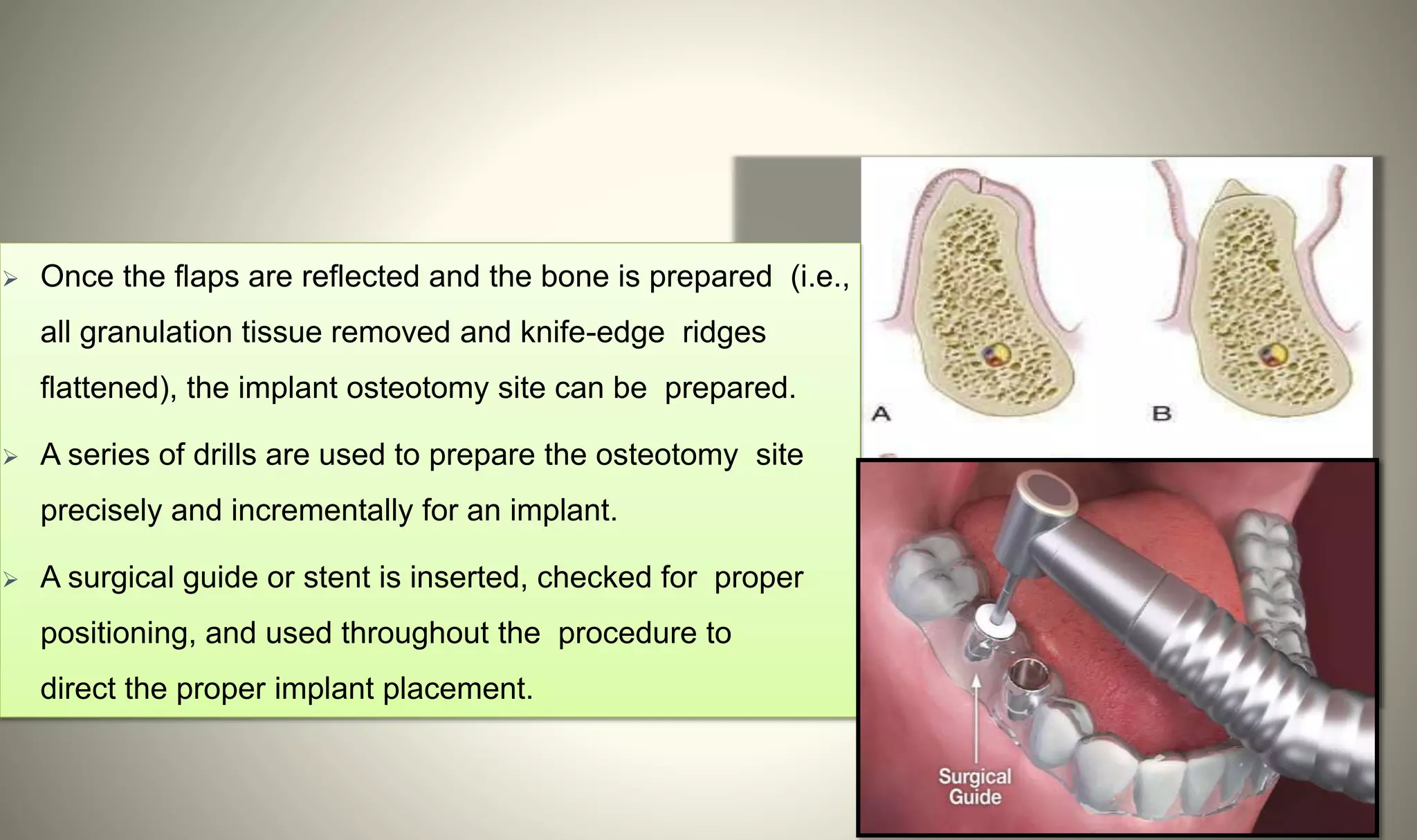 Standard implant surgical procedure.pptx
