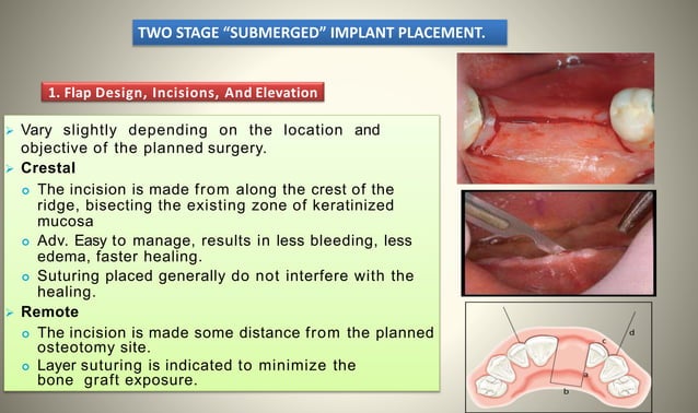 Standard implant surgical procedure.pptx