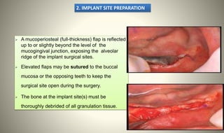 Standard implant surgical procedure.pptx
