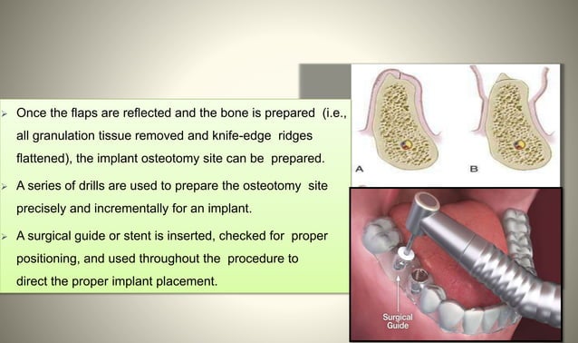 Standard implant surgical procedure.pptx