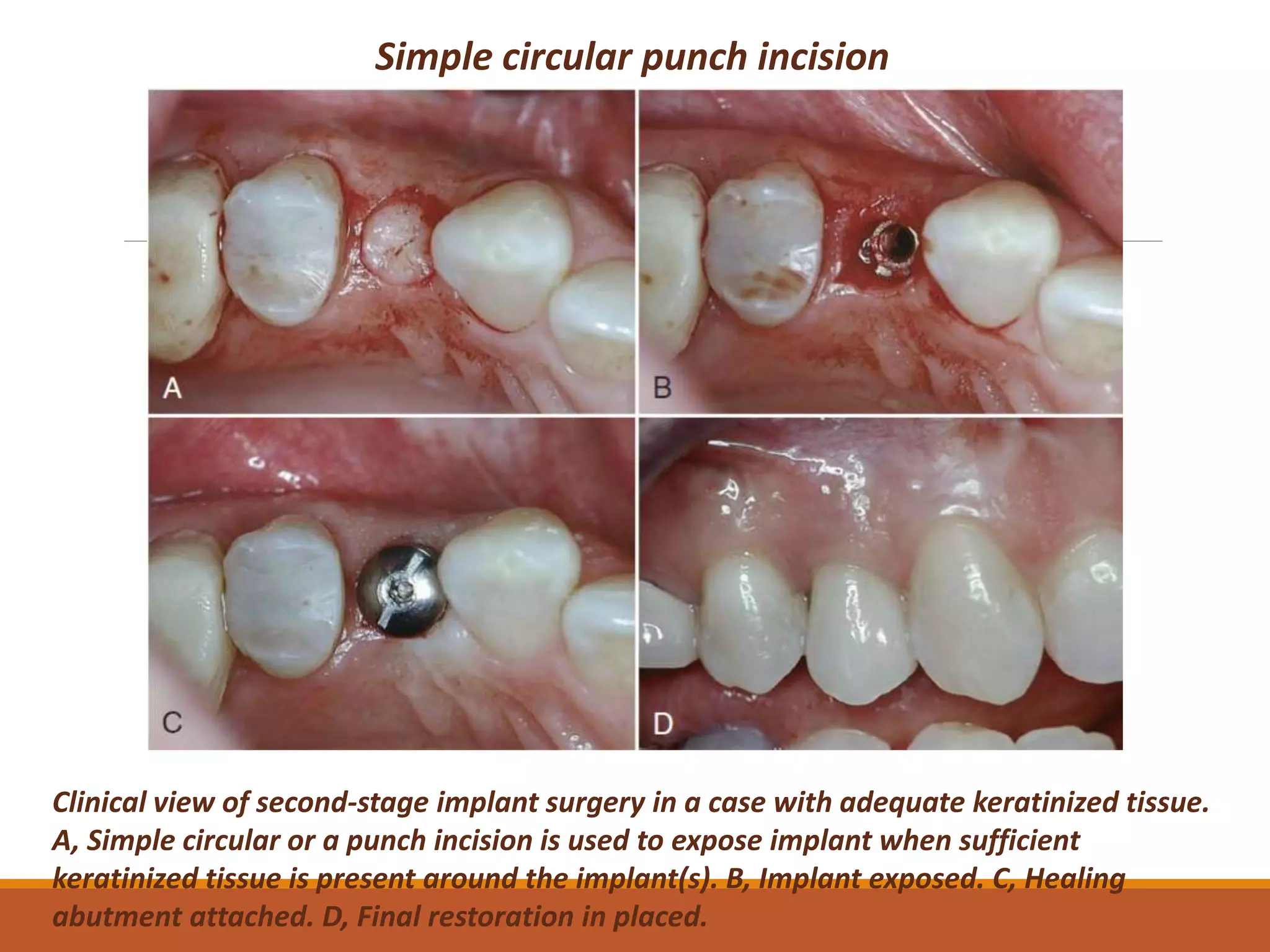 Standard implant surgical procedures | PPTX | Bone and Joint Conditions ...