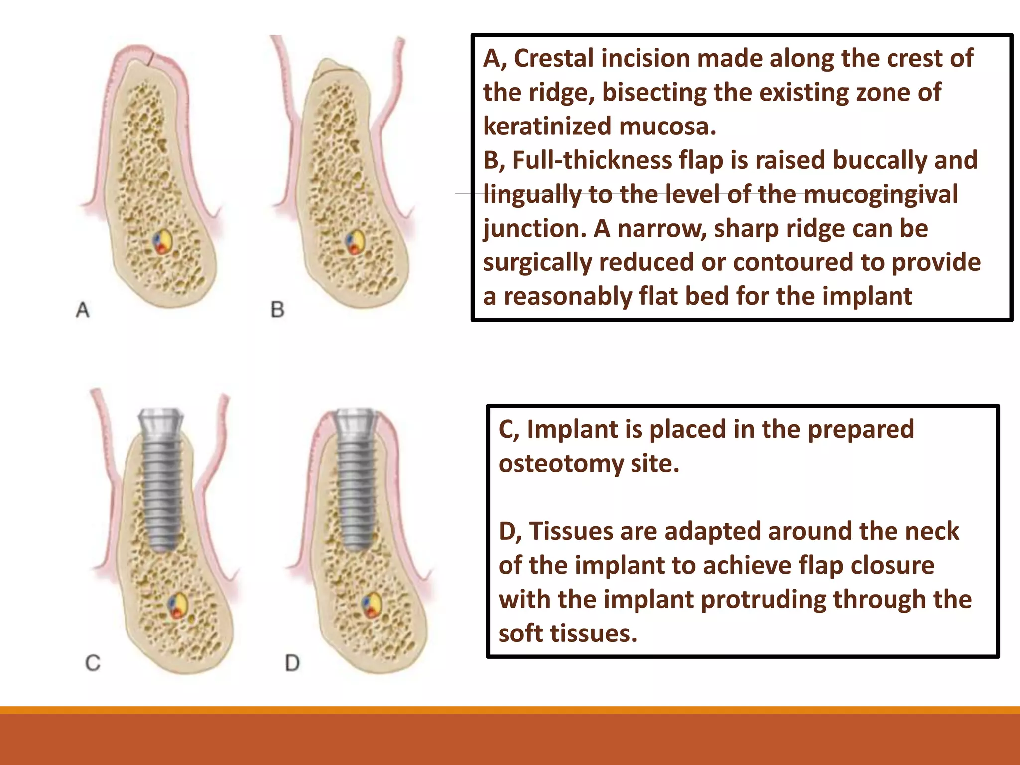 Standard implant surgical procedures | PPTX