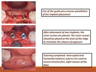Standard implant surgical procedures | PPTX