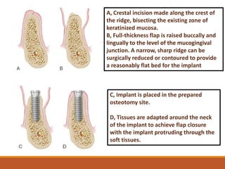Standard implant surgical procedures | PPTX