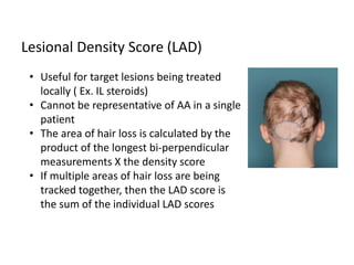 Standardizing Outcome Measures in Alopecia Areata | PDF