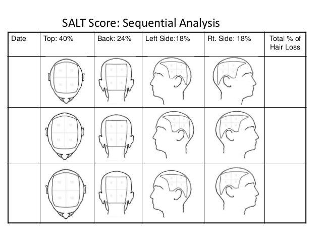 Standardizing Outcome Measures in Alopecia Areata