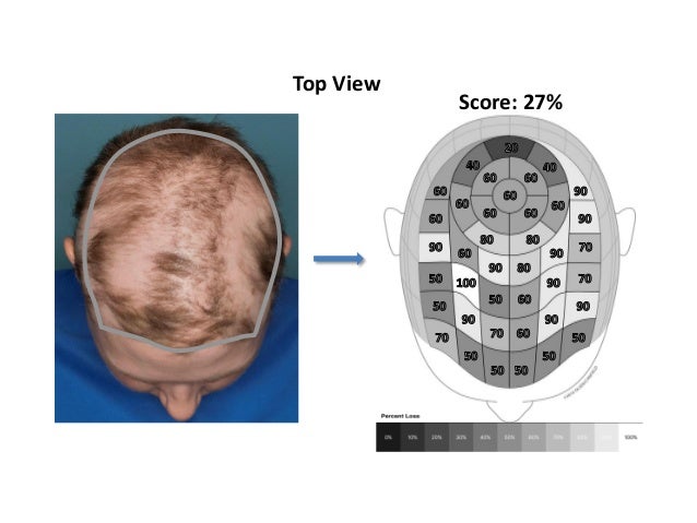 Standardizing Outcome Measures in Alopecia Areata