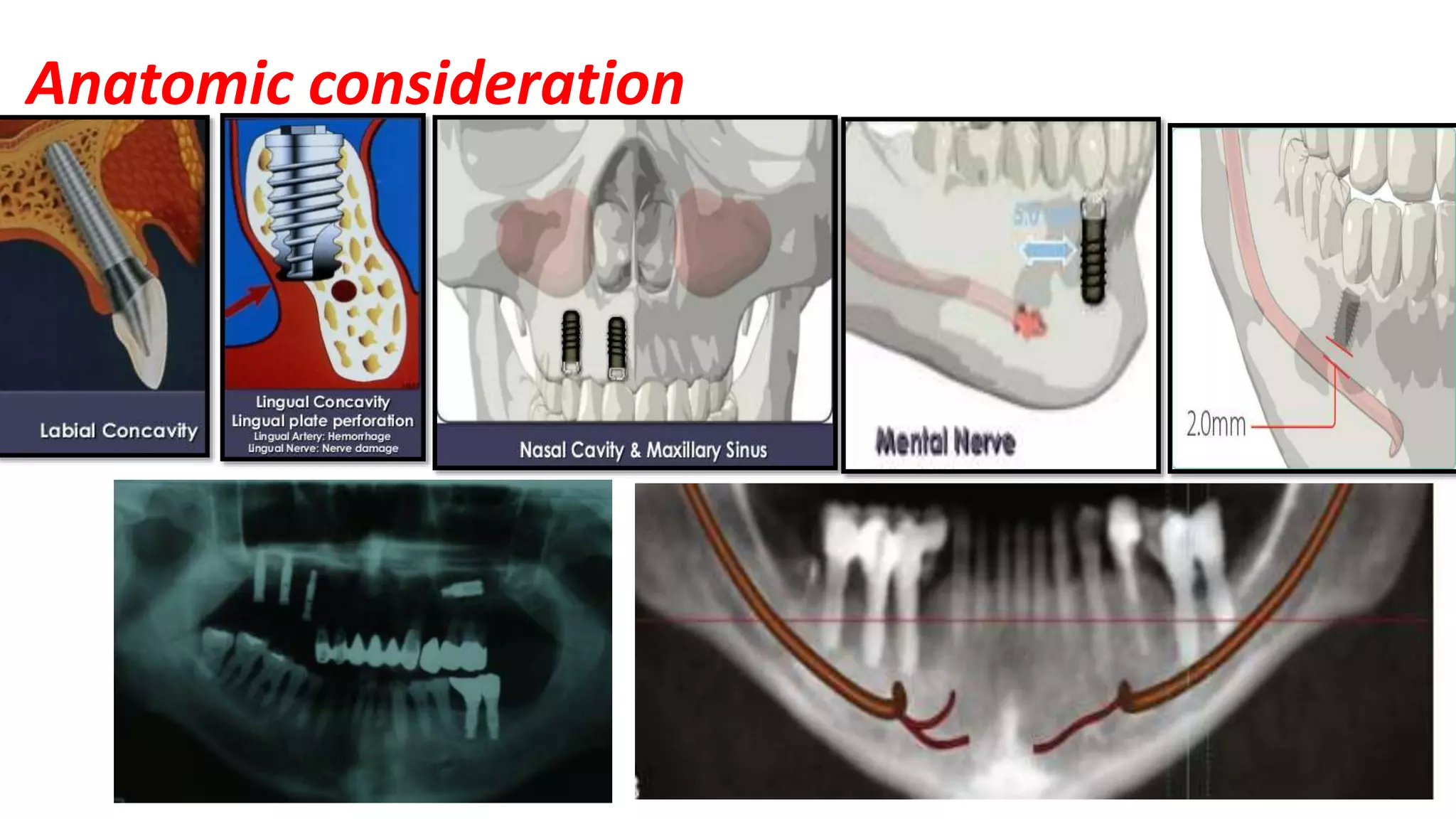 Standard surgical procedure for implant placement | PPTX