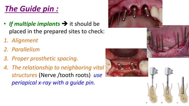 Standard surgical procedure for implant placement | PPTX | Dental Health | Diseases and Conditions