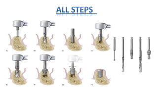 Standard surgical procedure for implant placement | PPTX