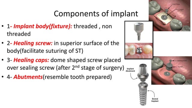 Standard surgical procedure for implant placement | PPTX | Dental ...