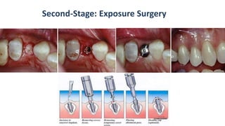 Standard surgical procedure for implant placement | PPTX