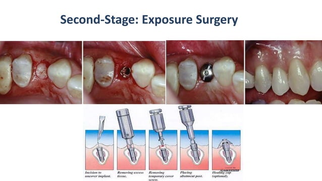 Standard surgical procedure for implant placement | PPTX | Dental Health | Diseases and Conditions