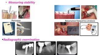 Standard surgical procedure for implant placement | PPTX