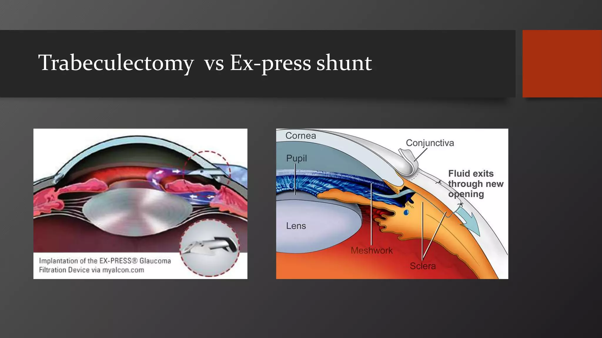 Standard trabeculectomy and ex press miniature glaucoma shunt | PPTX