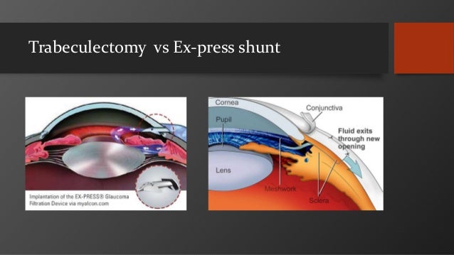 Trabeculectomy Express Shunt