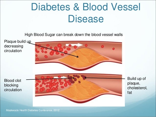 Diagnosed With Diabetes, Now What?