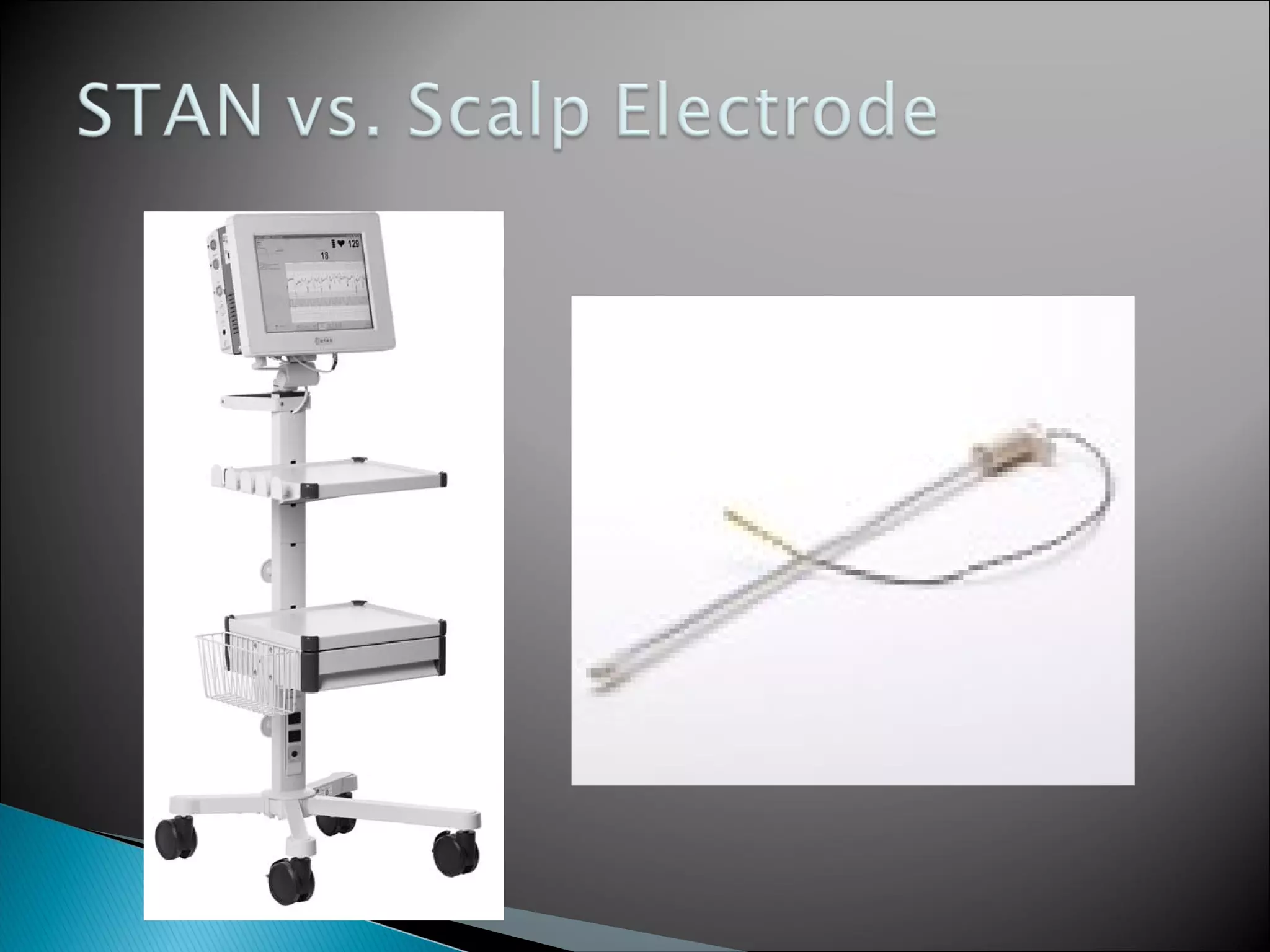 ST Segment Analysis (STAN) for Intrapartum Electronic Fetal Monitoring ...