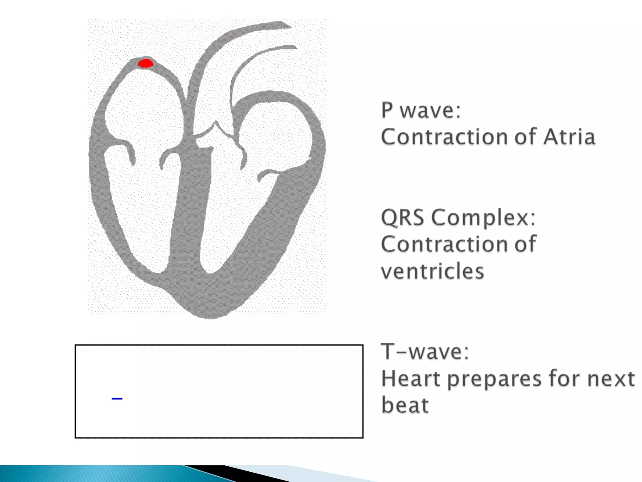ST Segment Analysis (STAN) for Intrapartum Electronic Fetal Monitoring ...