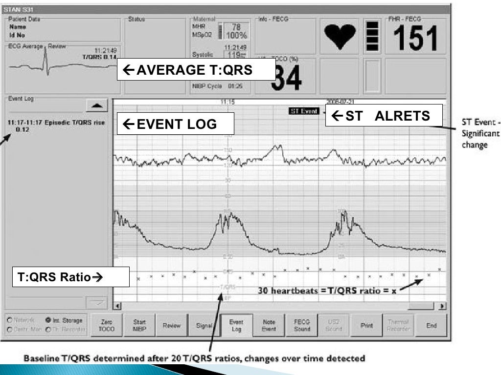 ST Segment Analysis (STAN) for Intrapartum Electronic Fetal Monitoring