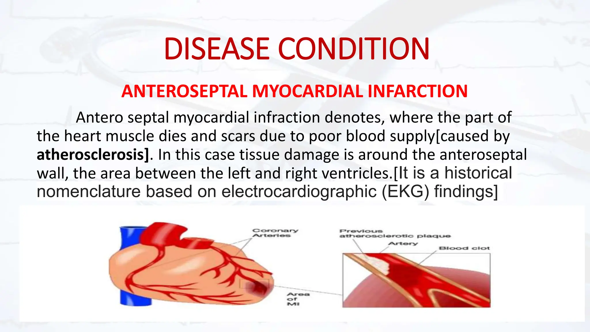 CASE PRESENTATION ON ANTEROSPECTAL MYOCARDIAL INFARCTION | PPTX