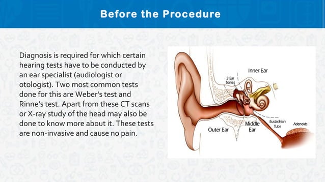 Stapedectomy | PPT