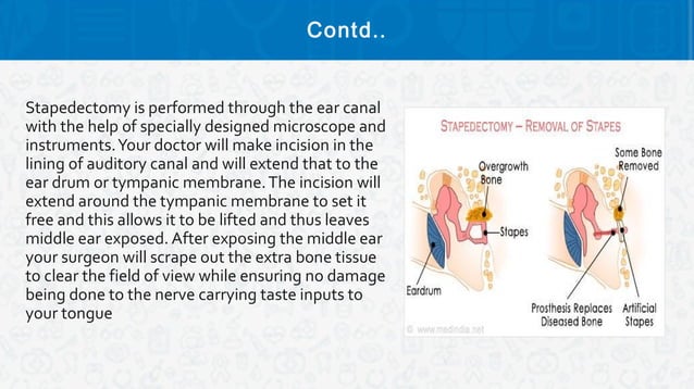 Stapedectomy | PPT