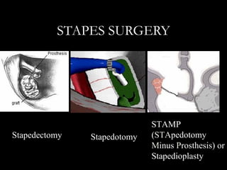 Stapes presentation | PPT
