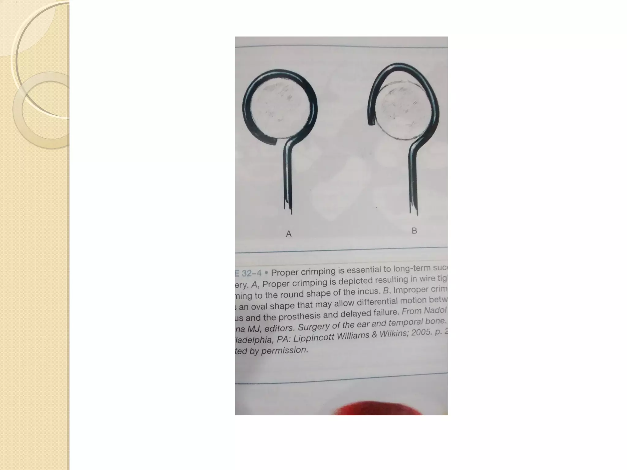 surgical management of ototsclerosis | PPT