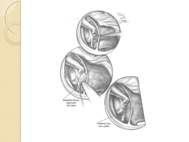 surgical management of ototsclerosis | PPT