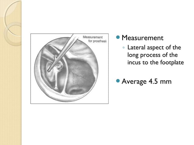 surgical management of ototsclerosis | PPT