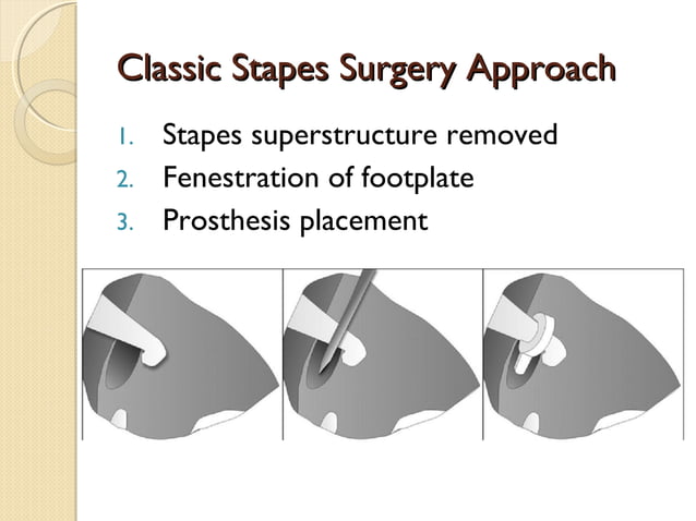 surgical management of ototsclerosis | PPT