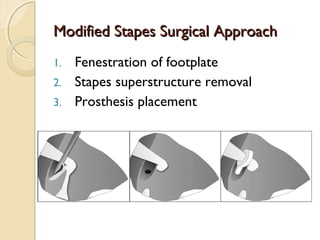 surgical management of ototsclerosis | PPT