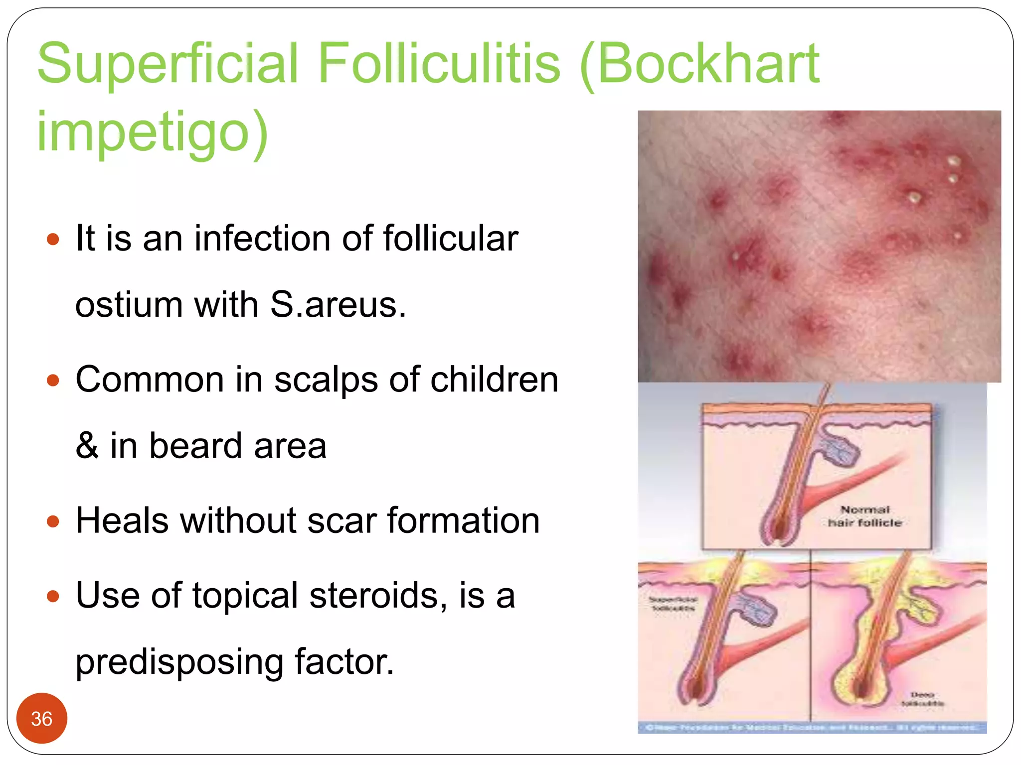 Staphylococcal & streptococcal skin infections | PPTX | Ear, Nose and ...
