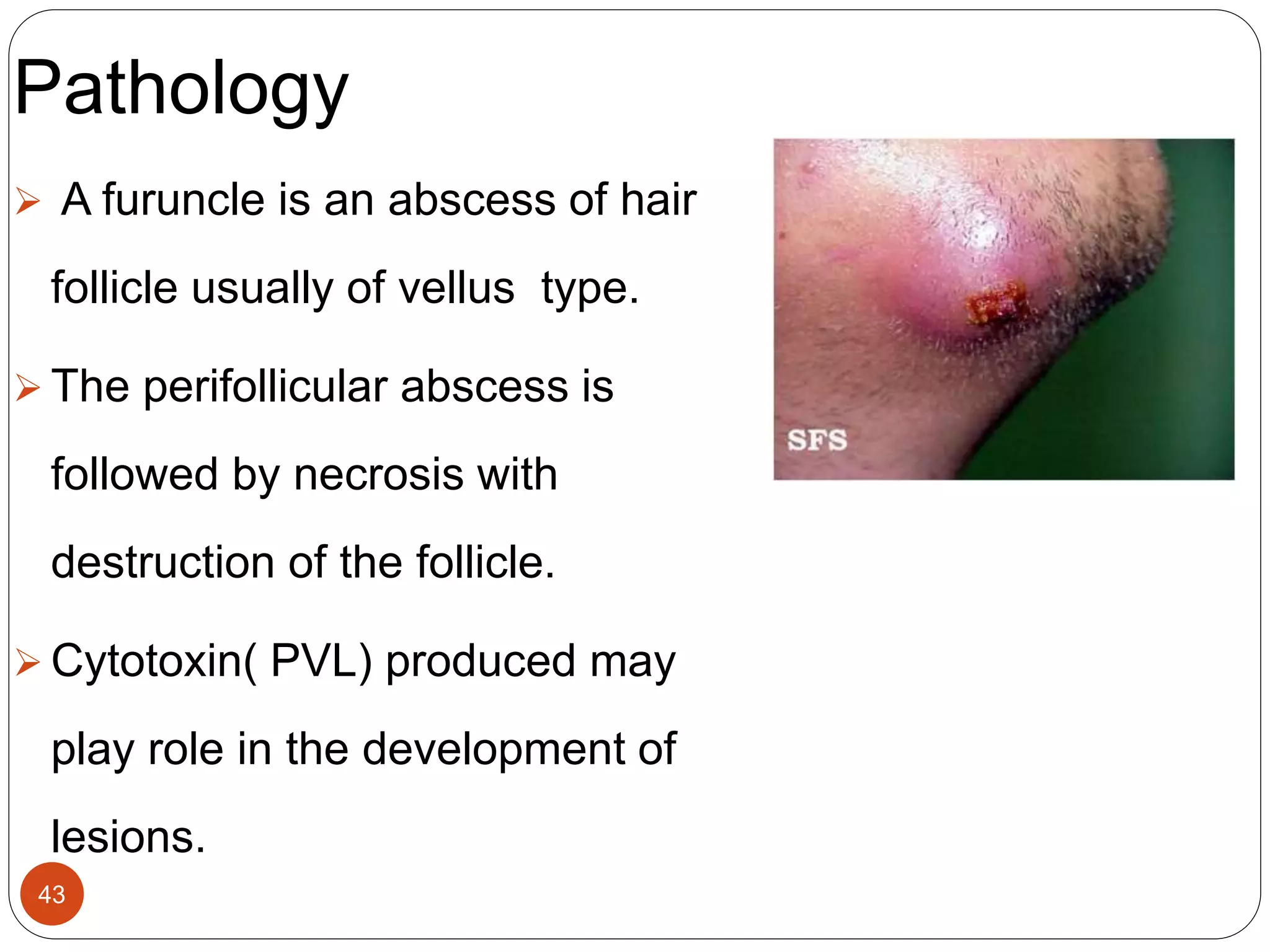 Staphylococcal & streptococcal skin infections | PPTX
