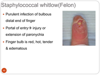 Staphylococcal Whitlow