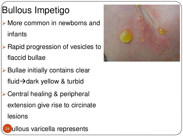 Staphylococcal & streptococcal skin infections