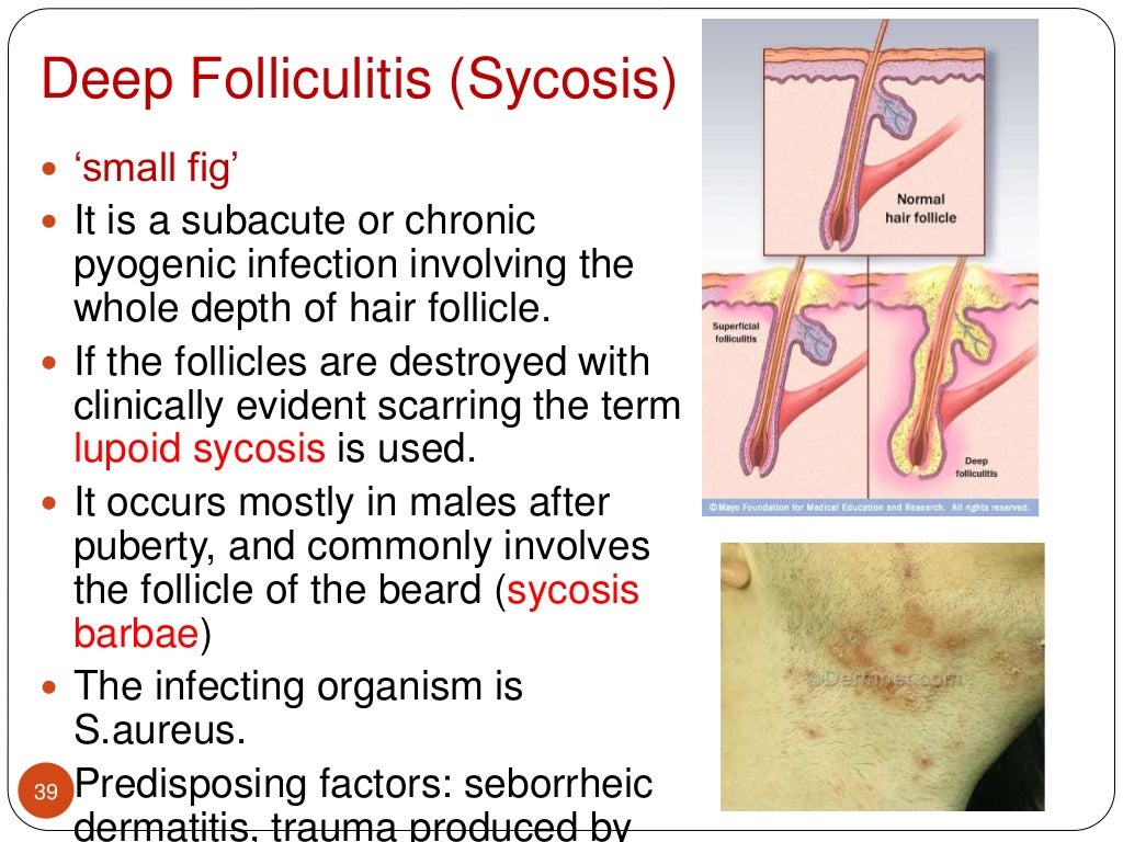 Staphylococcal & streptococcal skin infections